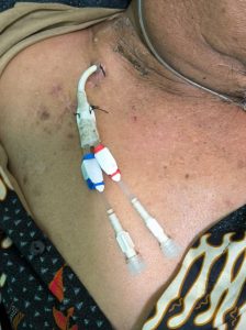 Mengenal Alat Cuci Darah HD cath atau CDL Temporer - dr_primabtkv