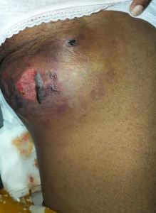 Mengenal Alat Cuci Darah HD cath atau CDL Temporer - dr_primabtkv